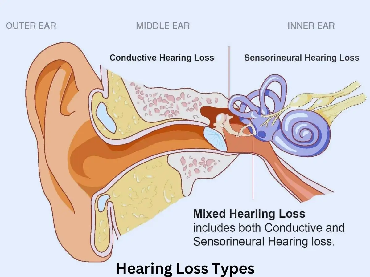 Hearing Loss in Pakistan: Types, Symptoms, Treatment & Cost